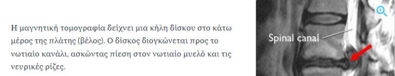 Δισκοκήλη στο κάτω μέρος της πλάτης